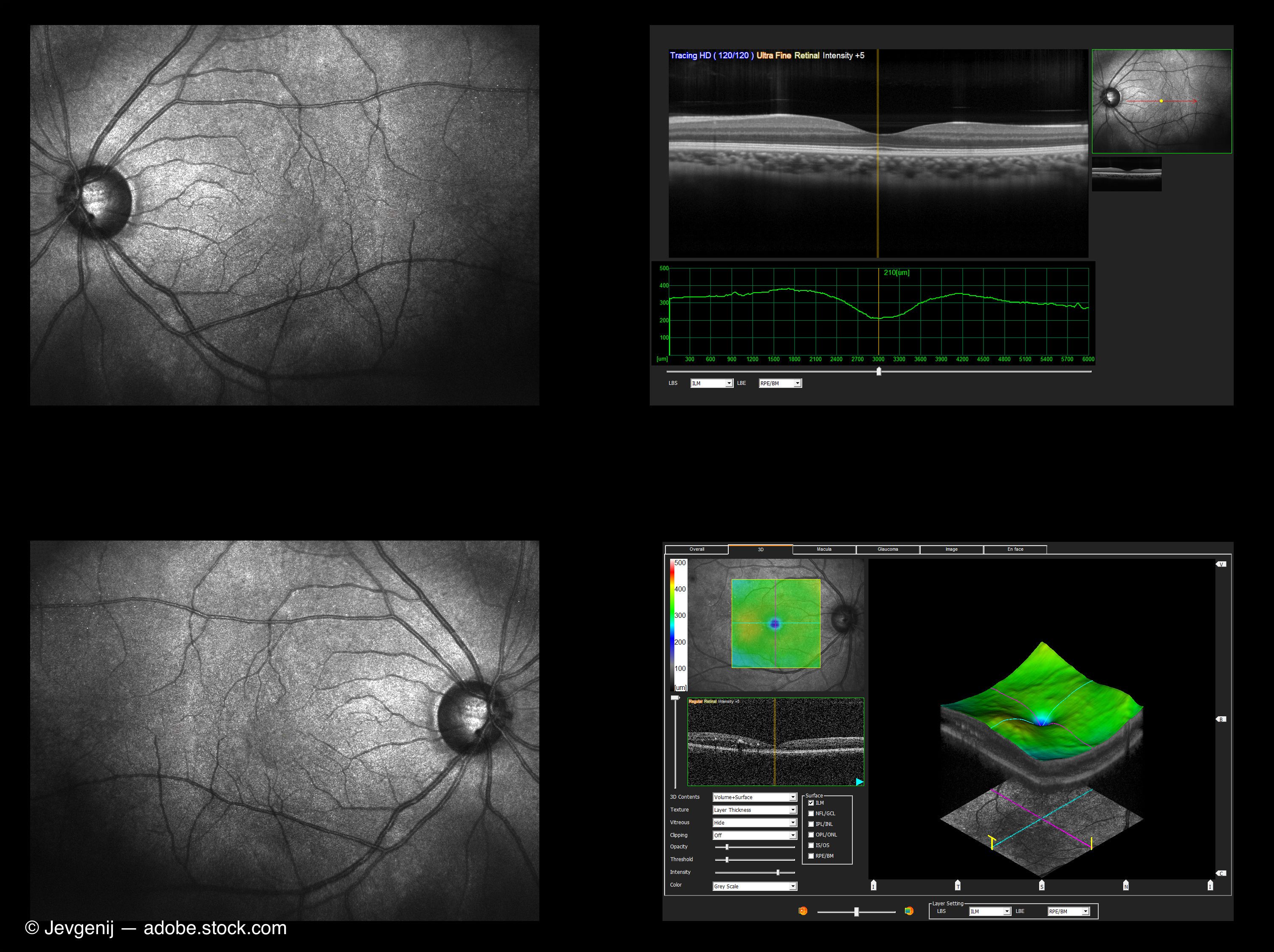 When and how to treat myopic traction maculopathy | Modern Retina