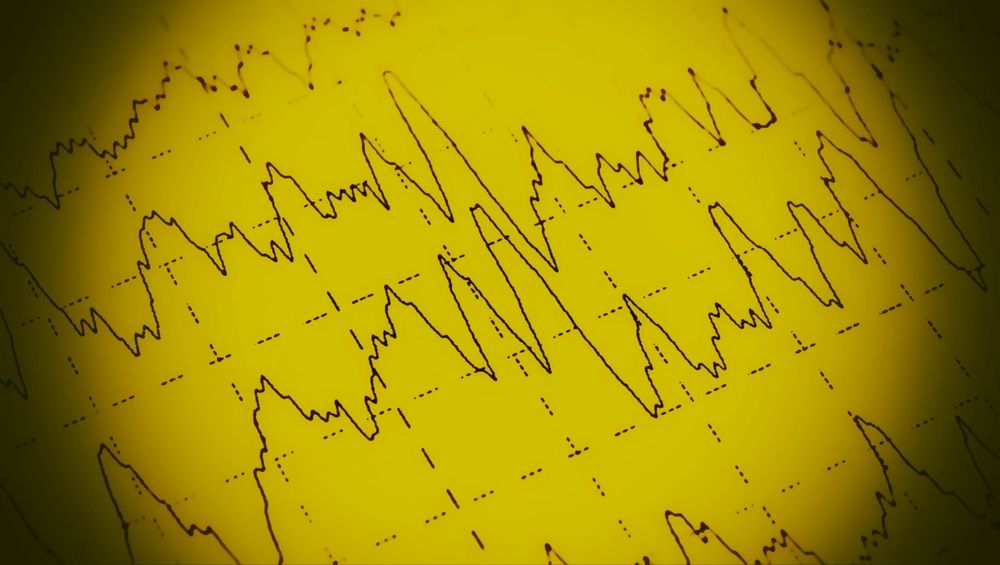 5 Important Facts About SUDEP | NeurologyLive - Clinical Neurology News ...