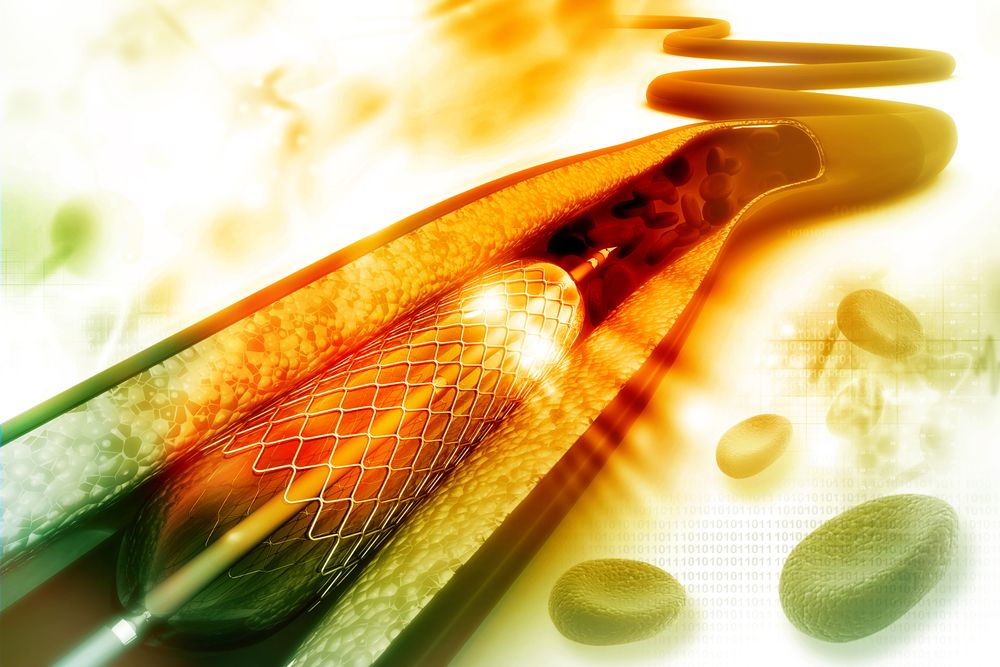 Stroke: Stenting or Bypass Surgery?