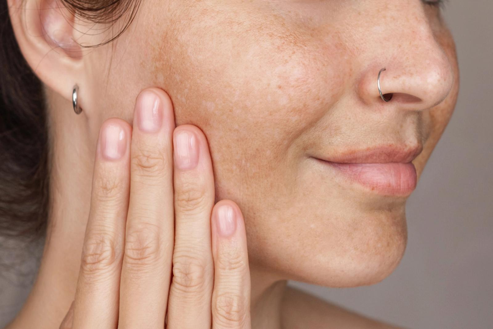 Laser or Microneedling? How to Know Which Treatment Your Skin Actually ...