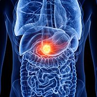 Glecirasib Receives Breakthrough Therapy Designation in China for KRAS ...