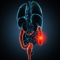 MSH3 IHC and Tetranucleotide MSI Analysis Should Not Be Routine in CRC