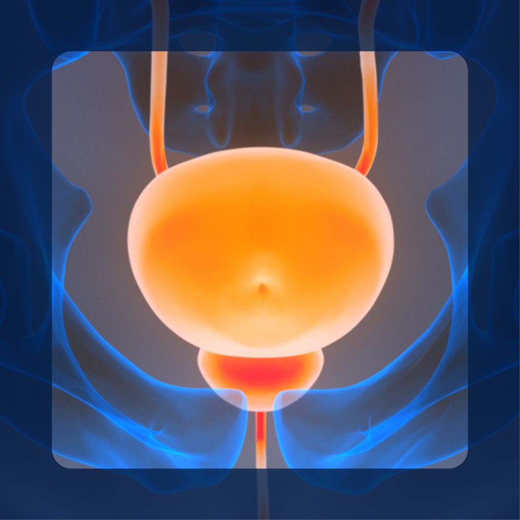 TAR-200 Produces Unprecedented CR Rates in BCG-Unresponsive, High-Risk ...