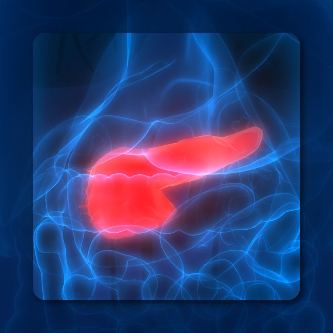 Dendritic Cell–Based Immunotherapy Data in Resected Pancreatic Cancer ...