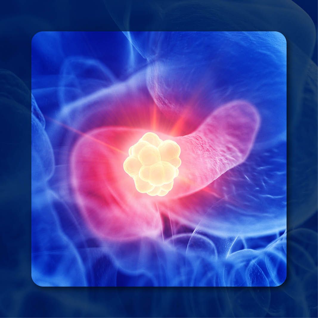 RAS(ON) Inhibitor Zoldonrasib Is Safe, Shows Early Activity Signals in ...
