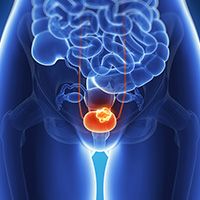New Bladder Cancer Monitor Allows Non-invasive Routine Surveillance of ...