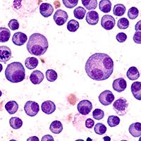 Cilta-cel Meets PFS End Point in Relapsed/Lenalidomide-Refractory ...