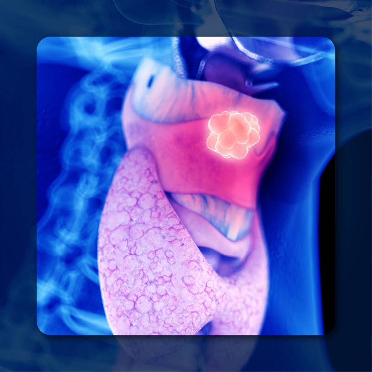 AVA6000 Generates Early Efficacy, Is Safe in Advanced Salivary Gland ...