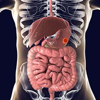 IMX-110 Plus Tislelizumab Leads to Tumor Shrinkage in Heavily ...