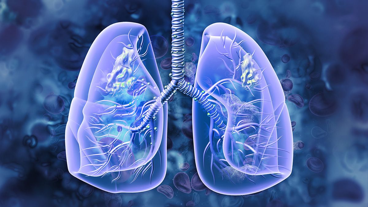 FDA Approves Subcutaneous Amivantamab Monthly Dosing in EGFR+ NSCLC ...