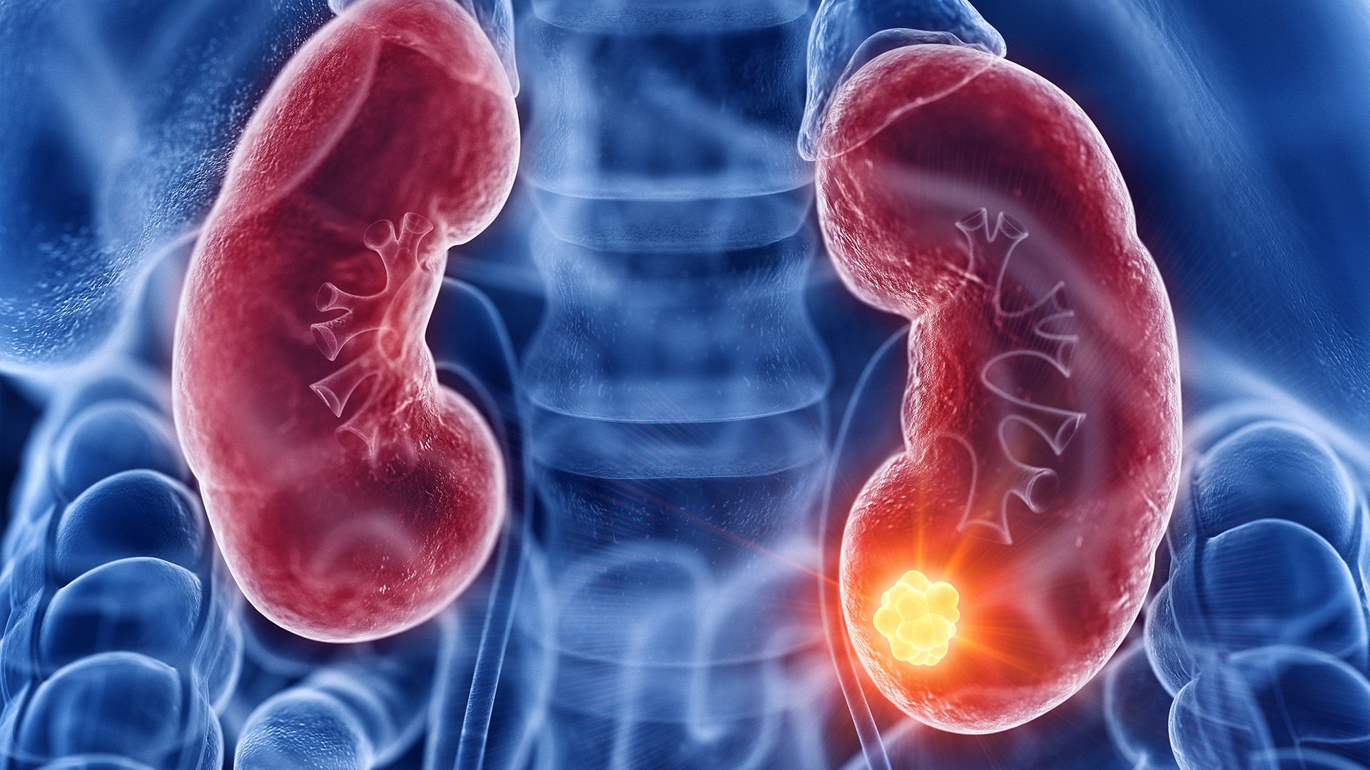 Linking Patient Experience With Next Steps in Renal Cell Carcinoma ...