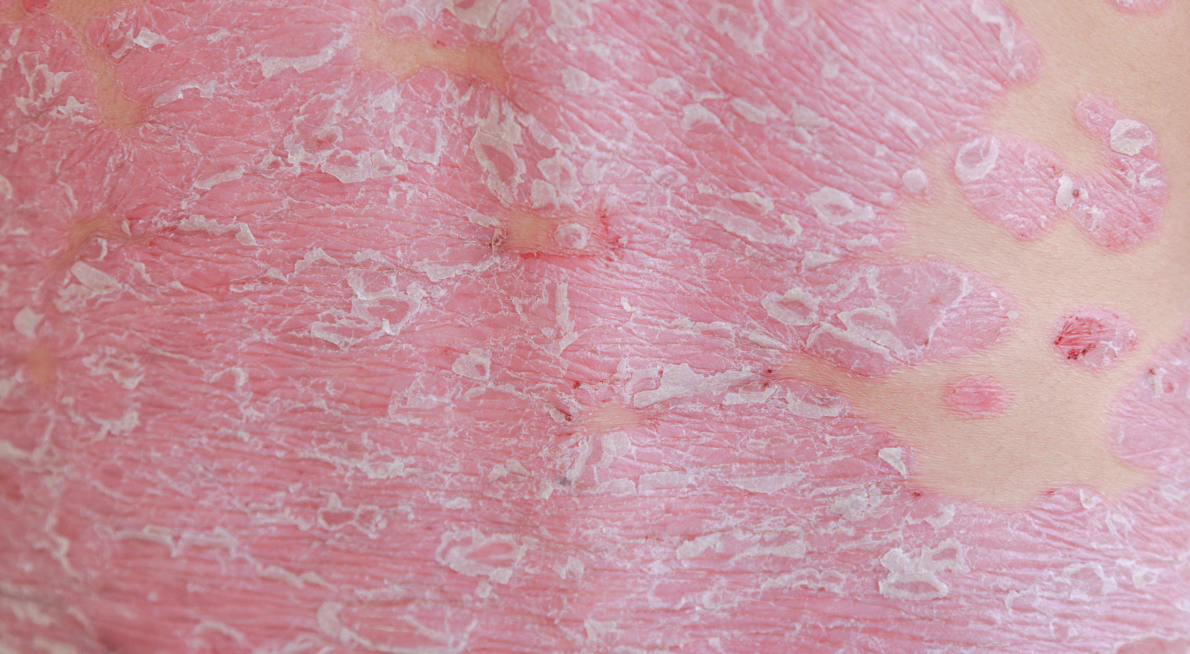 Dermatologic Adverse Events in Melanoma: What to Look Out For