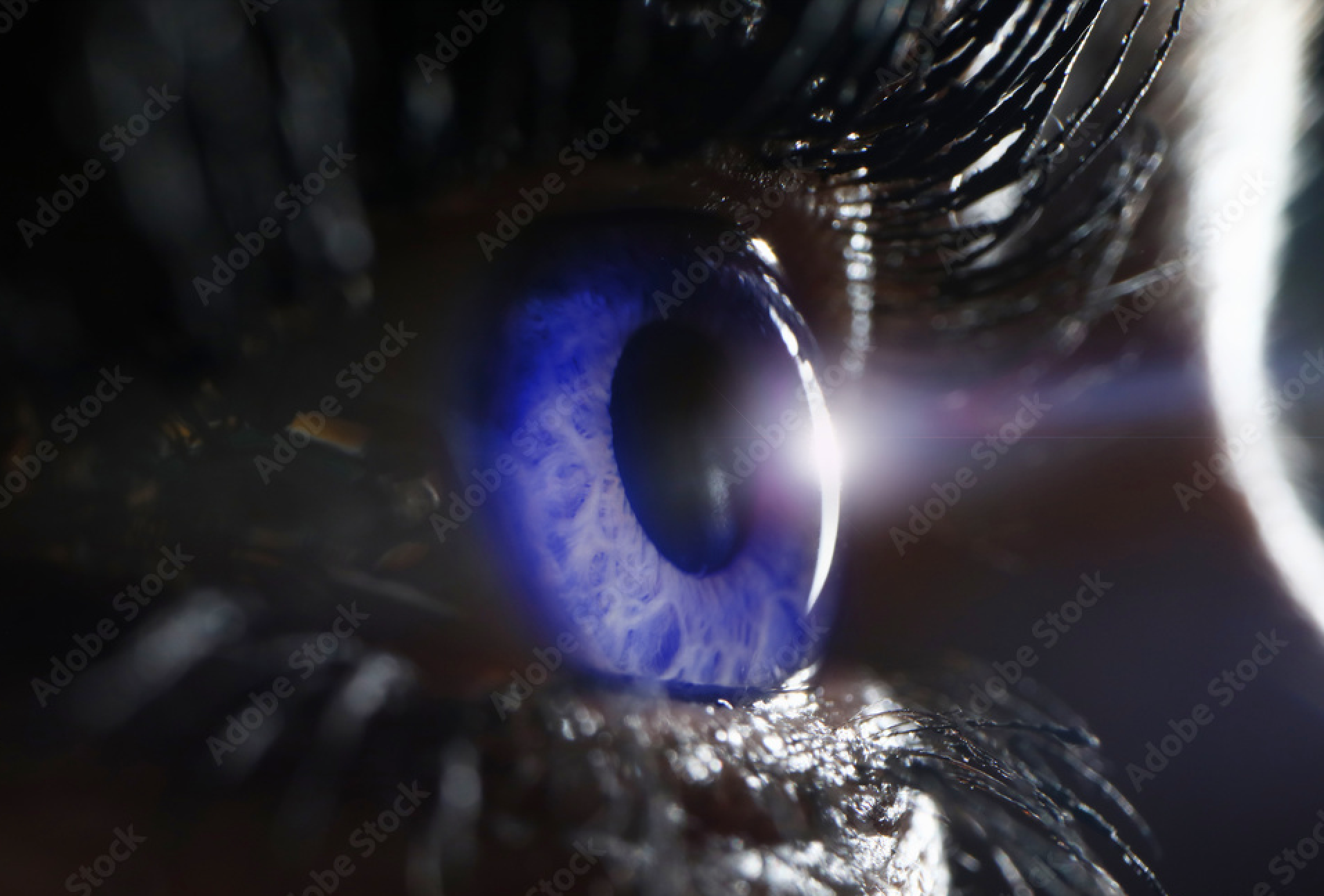 ARVO 2023: Presentations highlight suprachoroidal injection delivery ...