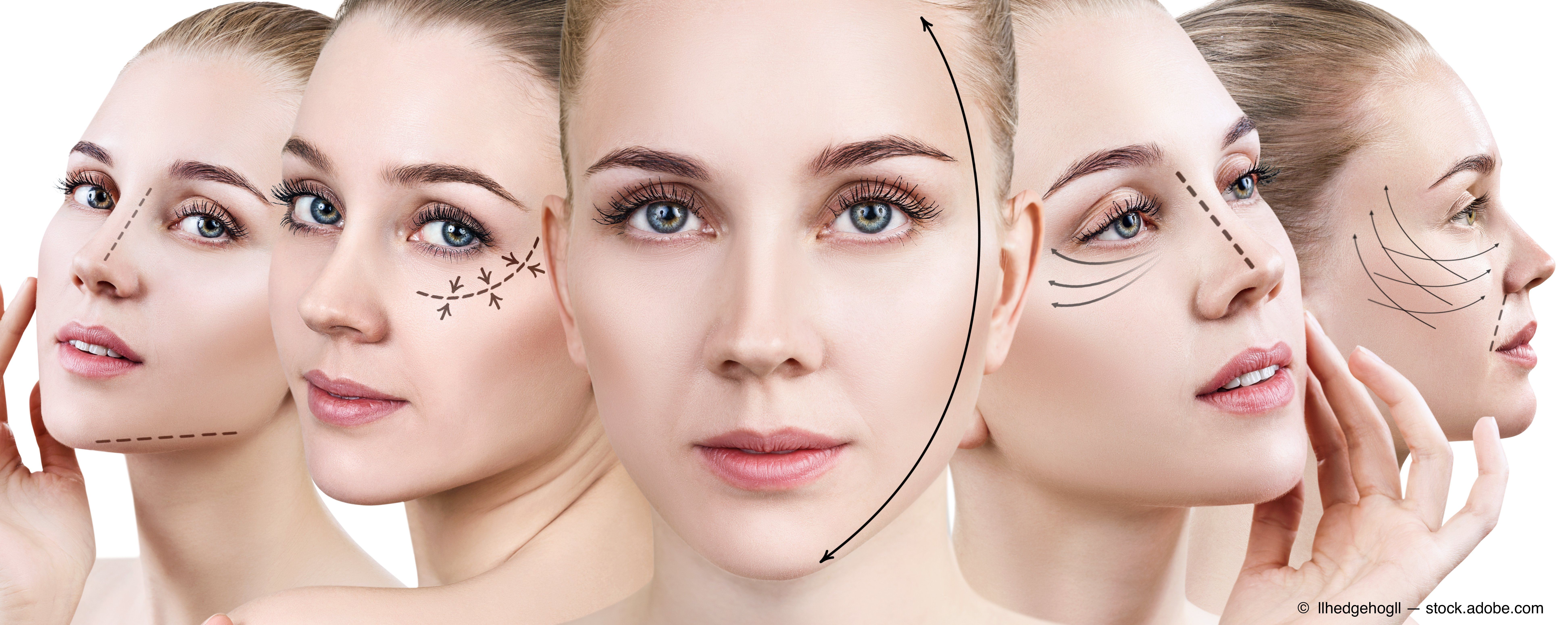 Advice on aesthetics in ophthalmology | Ophthalmology Times - Clinical ...