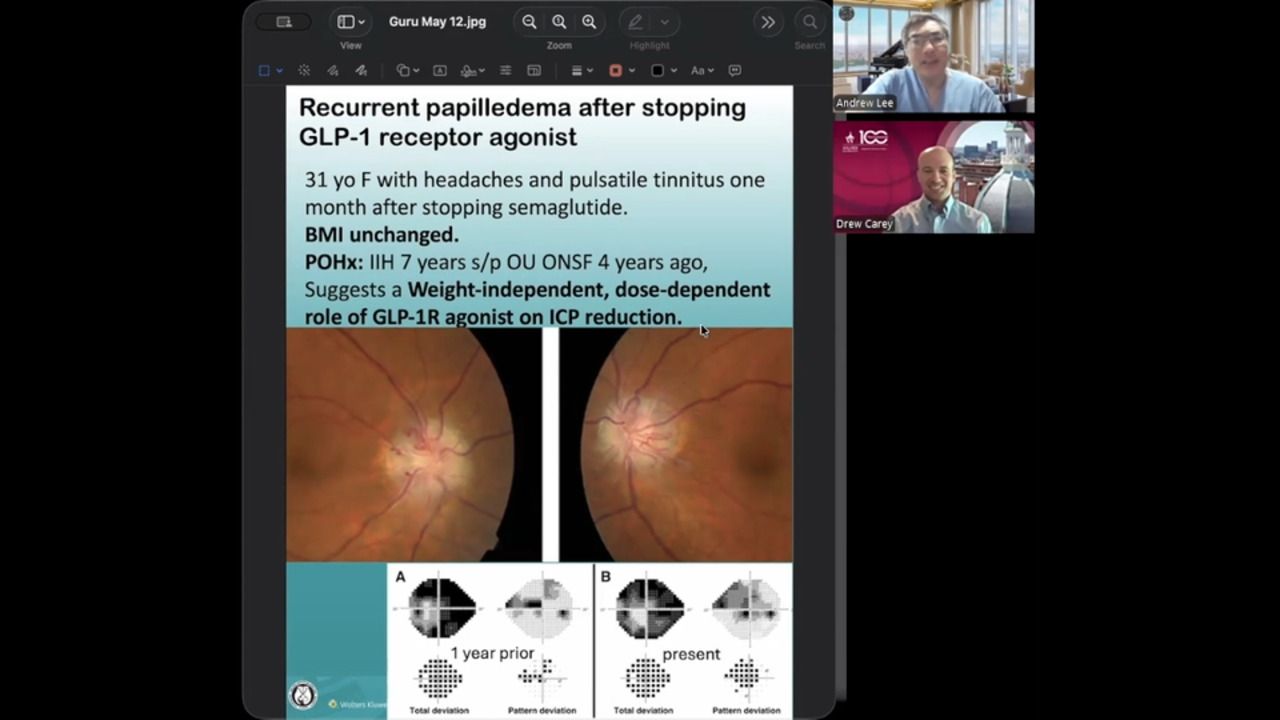 NeuroOp Guru: Stopping GLP-1 therapy may trigger recurrent papilledema ...