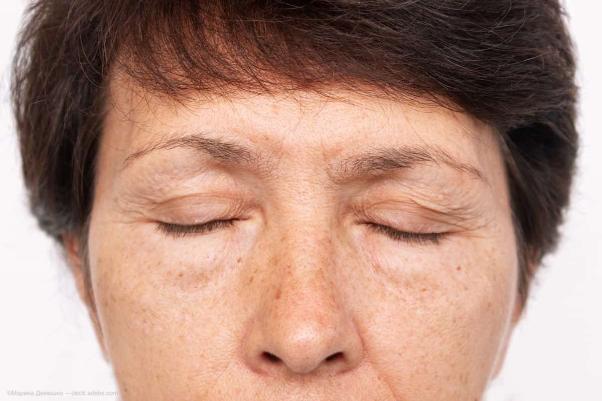 Eye-opening effects resulting from modified transconjunctival lower ...