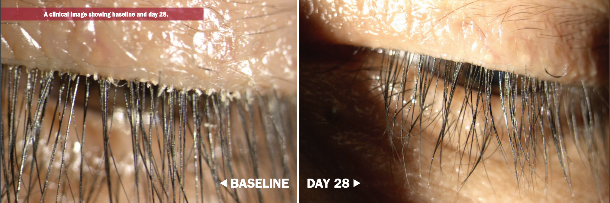 Drop shows effectiveness for Demodex blepharitis in phase 2a study ...