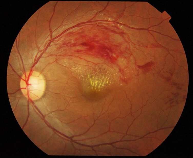 NIH study finds vision improvement is long-lasting with treatment for ...