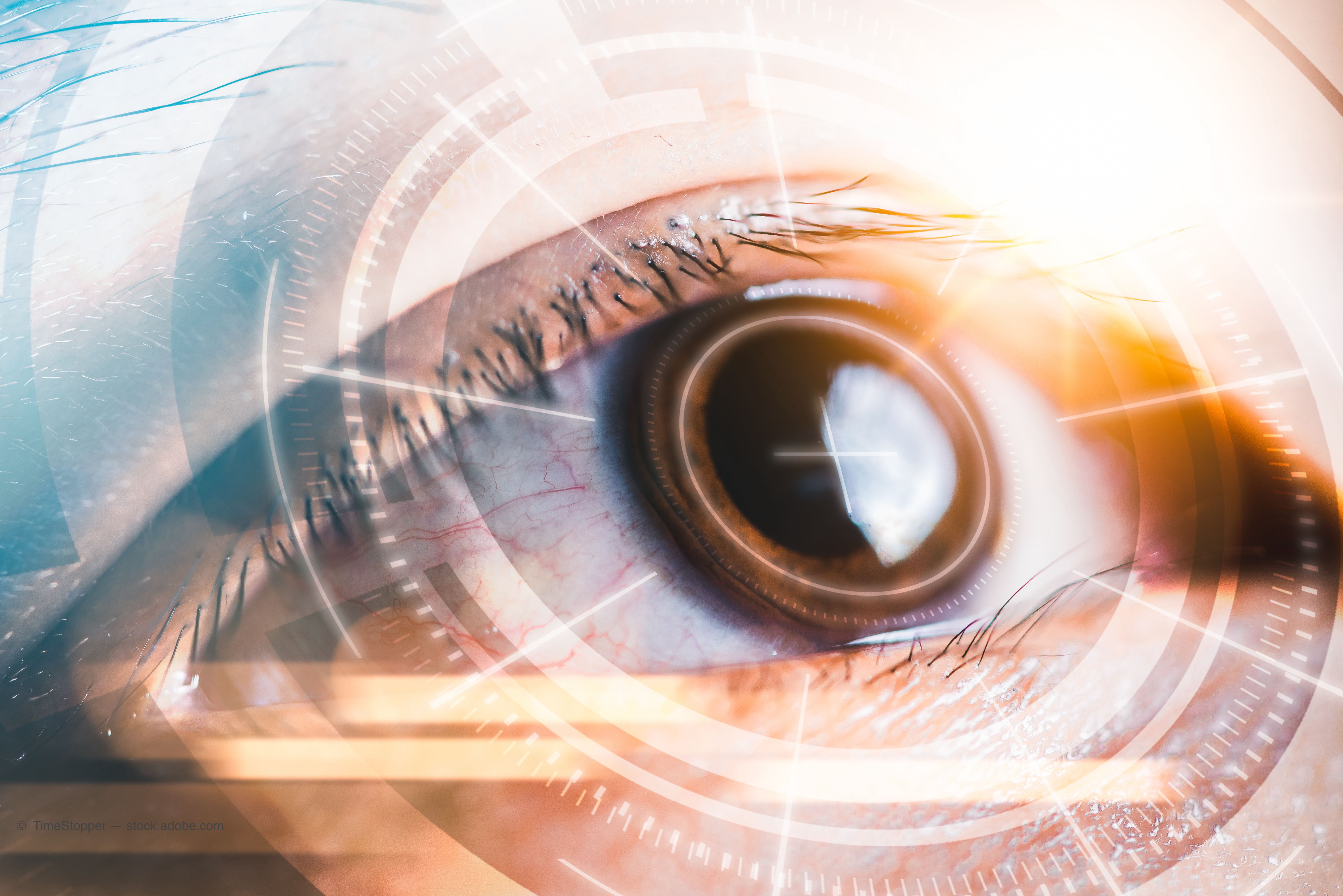 Home monitoring of wet AMD offers high-quality scans