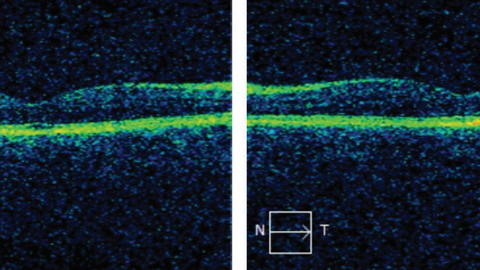 OCT | Ophthalmology Times
