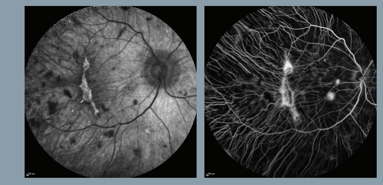 Gene therapy offers hope for choroideremia | Ophthalmology Times Gene therapy offers hope for choroideremia | Ophthalmology Times