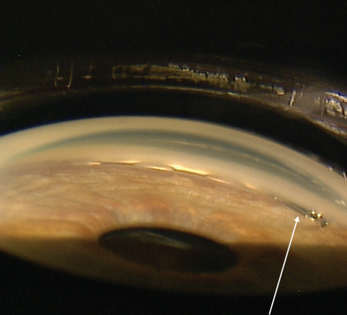 Advances in cataract surgery show value in tools, tech for surgeons