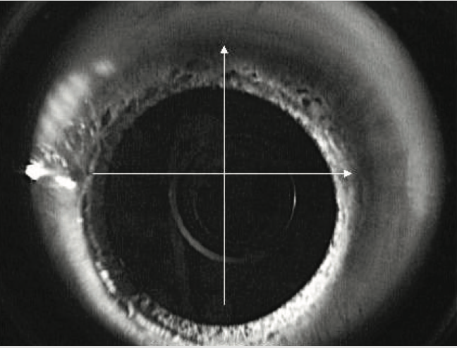 Benefits of topography-guided treatments for irregular corneas