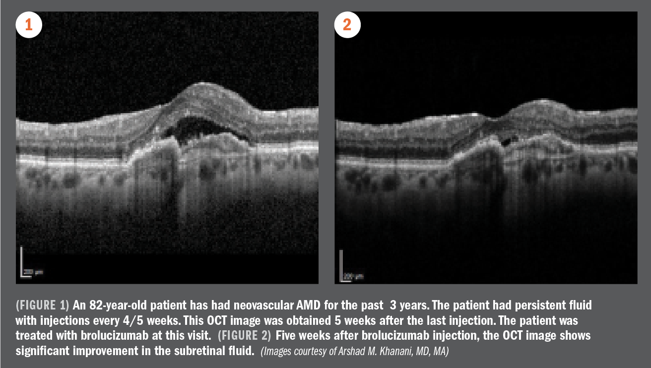 Brolucizumab: Less frequent dosing/maintenance of robust visual gains ...