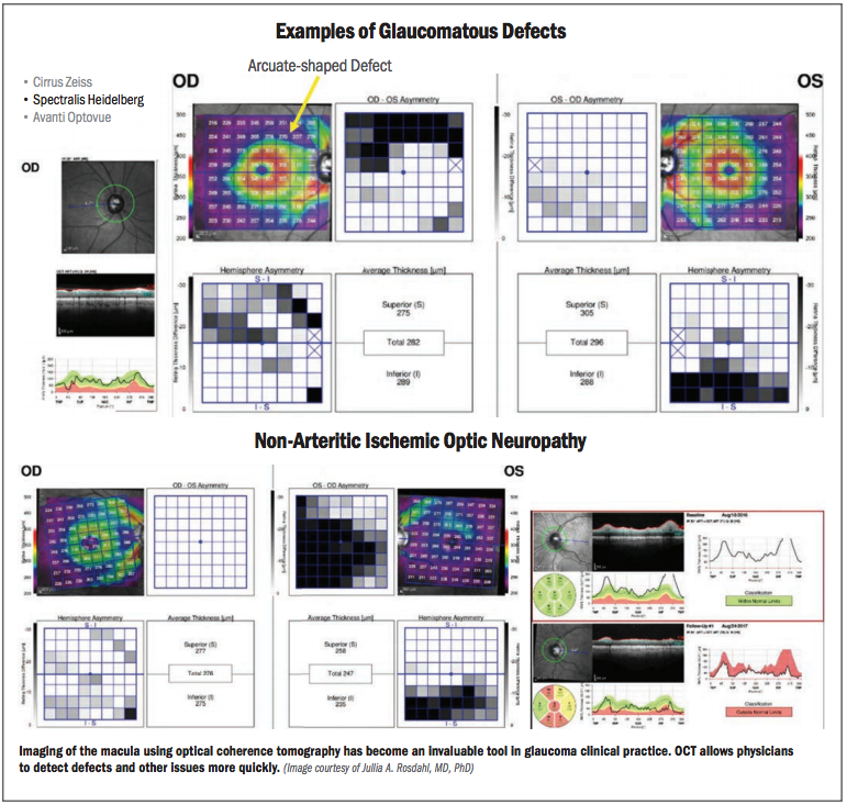 Glaucoma Oct Results