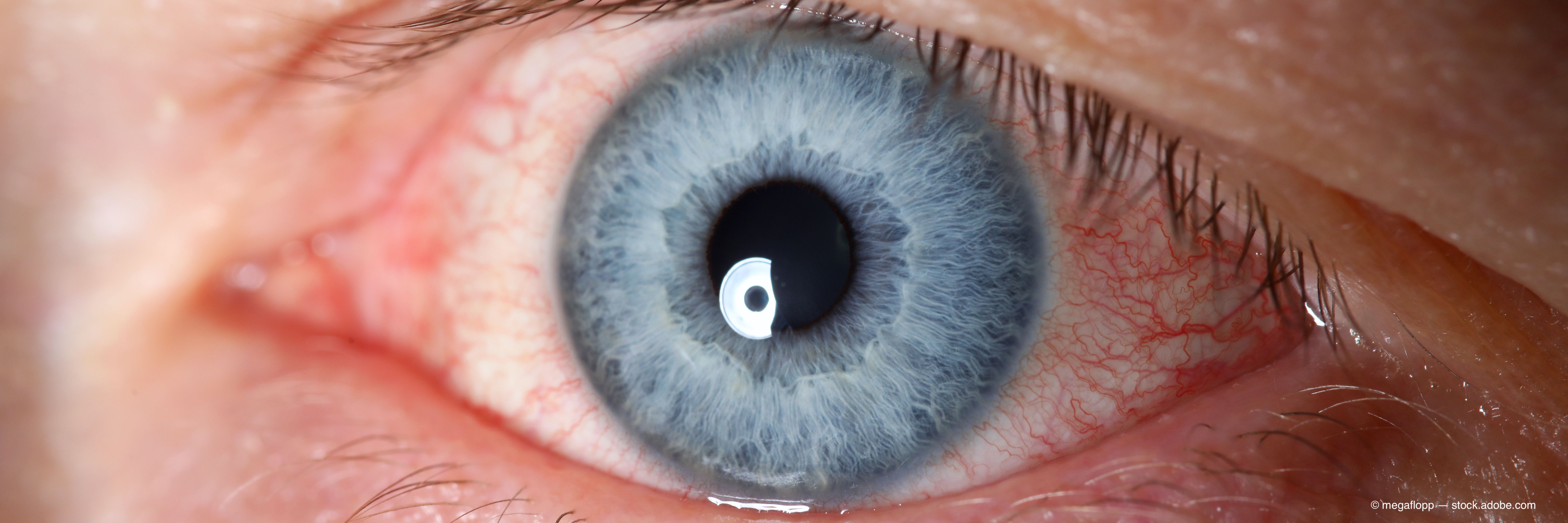 Amid pandemic, friendly bugs can help protect the eye from infection ...