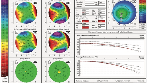 Cornea | Ophthalmology Times