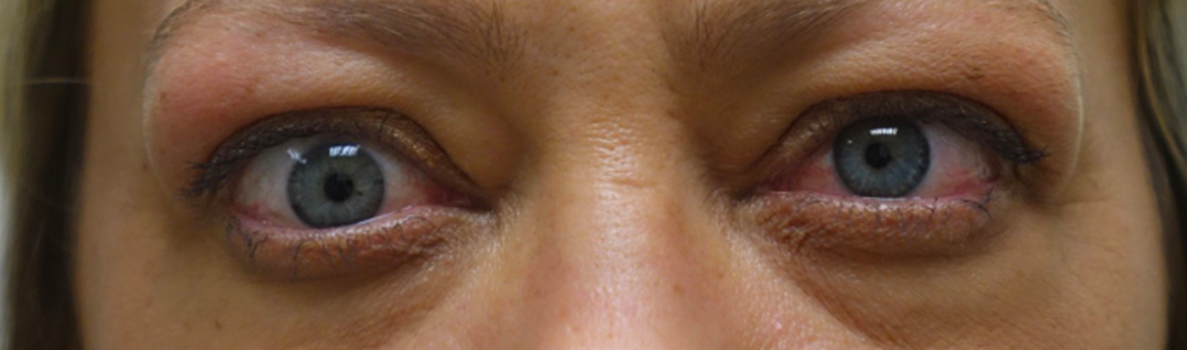 A new tool to treat TED | Ophthalmology Times - Clinical Insights for ...