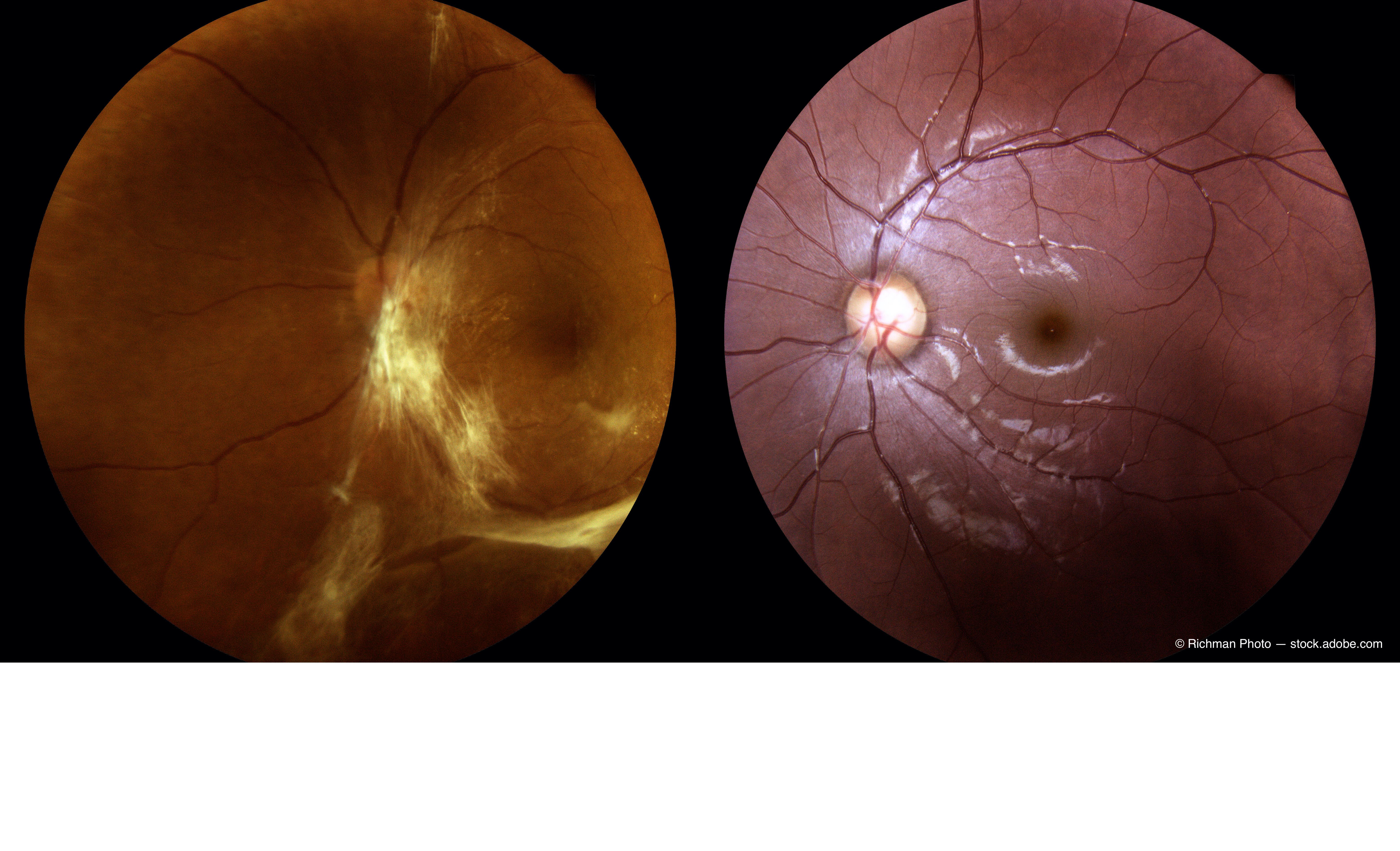 Anti-VEGF monotherapy targets vitreous hemorrhages in PDR ...