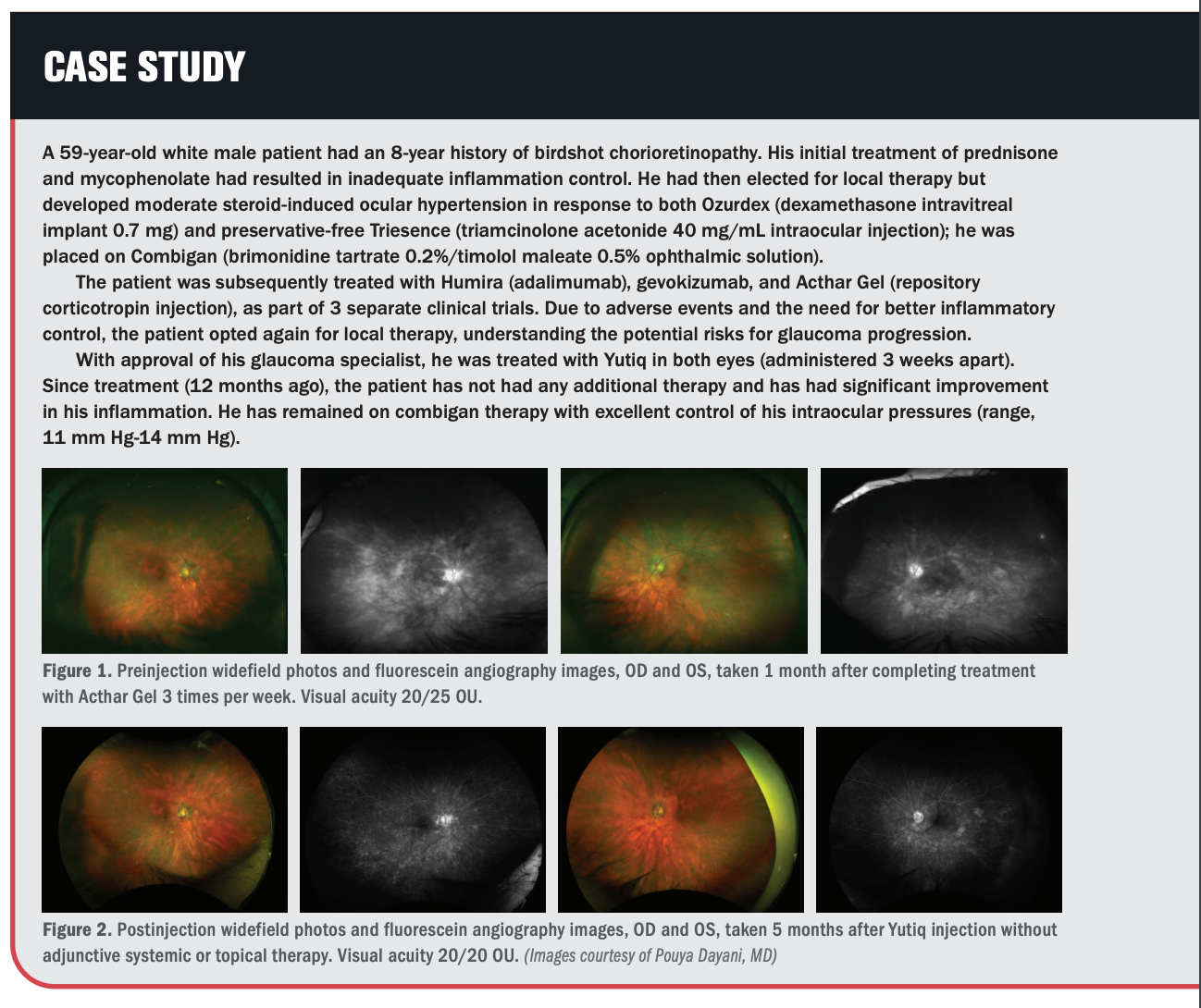 Tackling The Challenge Of Noninfectious Uveitis