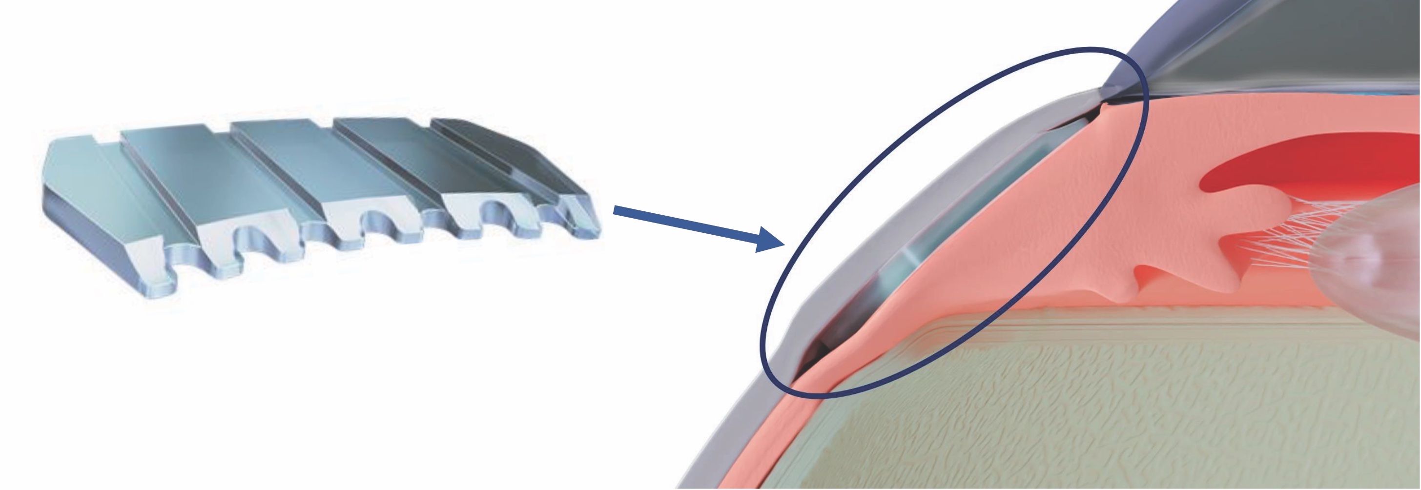 New glaucoma treatment development: the cilioscleral technique