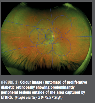Ultra-widefield imaging contributes to earlier disease detection
