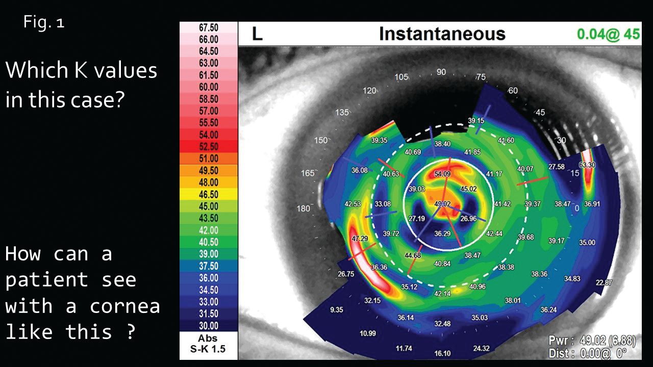 Distorted corneas: How to regularise them with minimally invasive ...