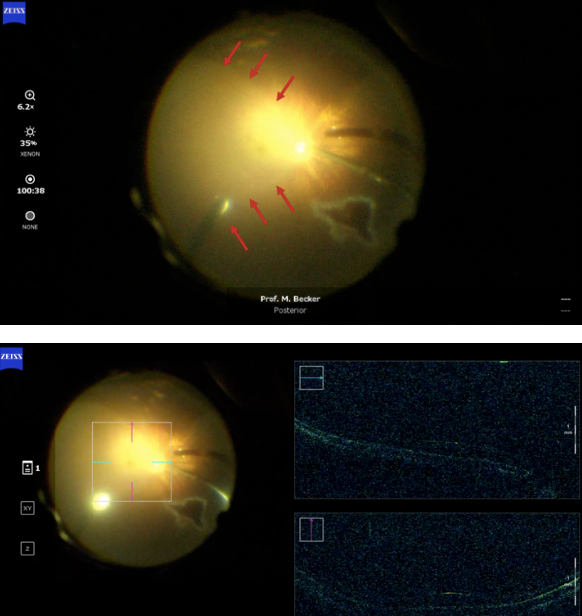 Case study: Complex retinal detachment in presumed genetic ...