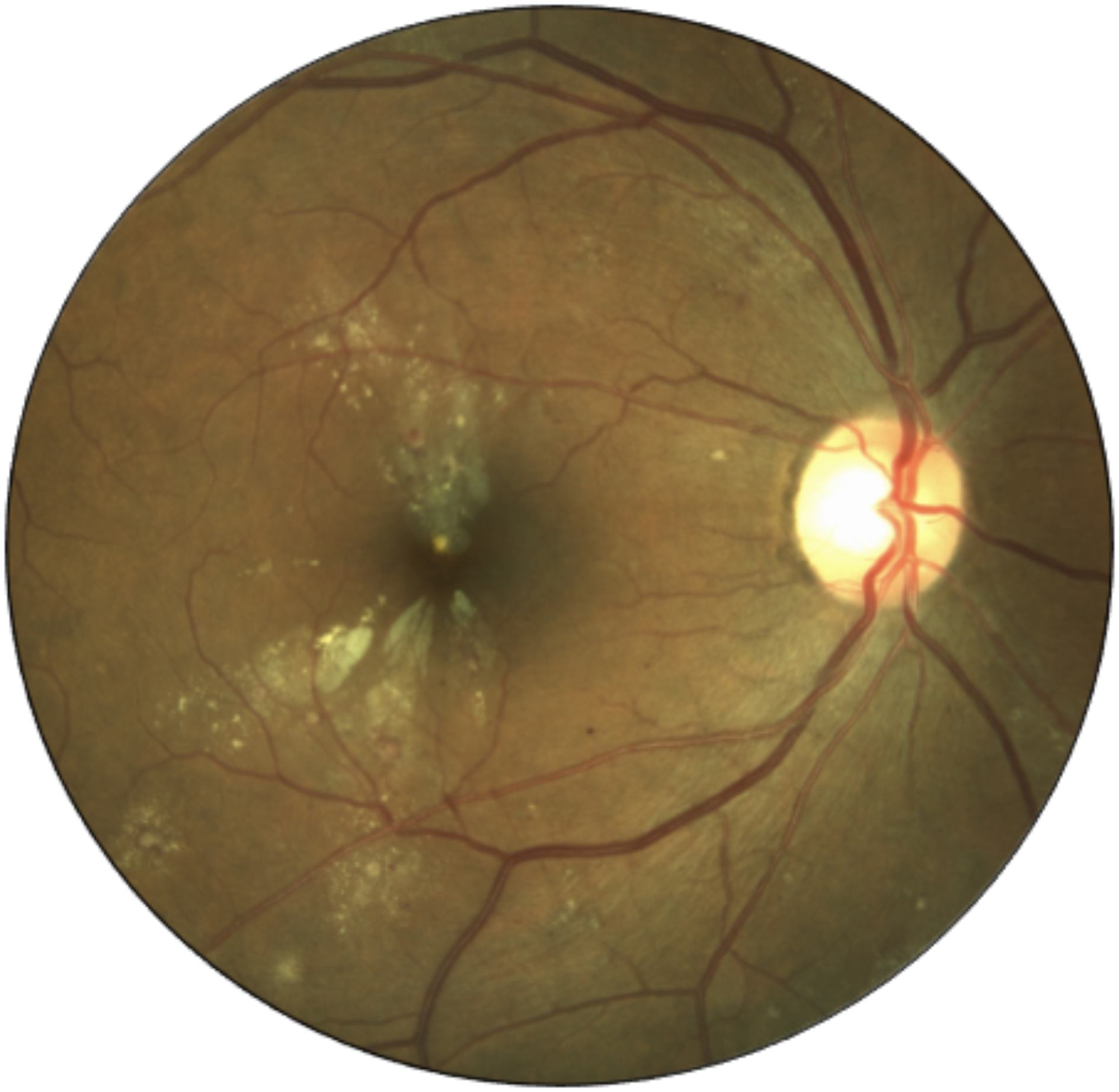 Diabetic retinopathy clinical pearl pictorial | Optometry Times