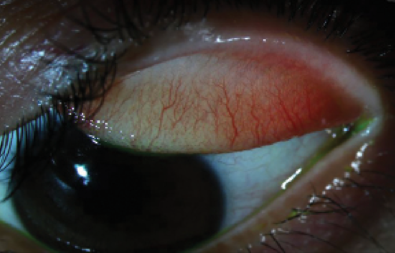 Don’t forget to flip the lids in keratoconus | Optometry Times ...