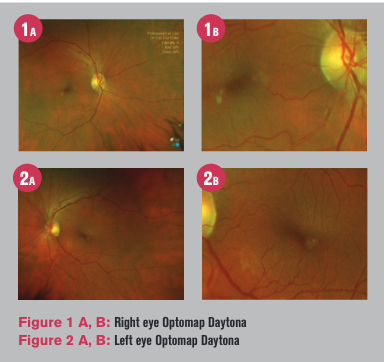 More than a yellow lesion? | Optometry Times - Clinical News & Expert ...