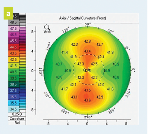 Normal Corneal Topography