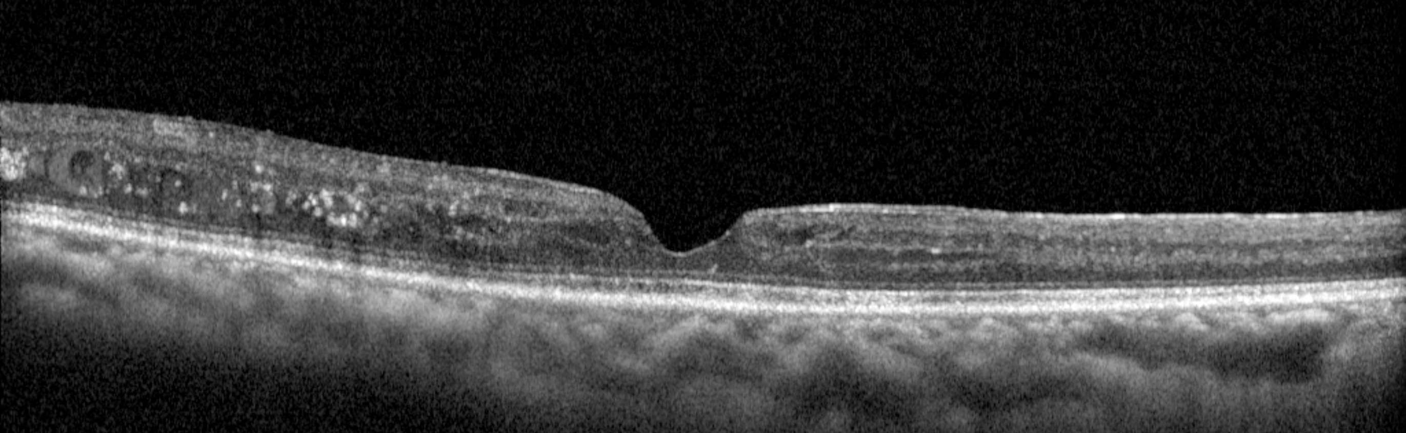 Diabetic retinopathy clinical pearl pictorial | Optometry Times