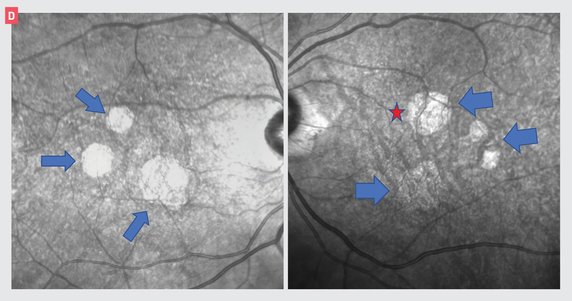 Geographic atrophy: What to know and why