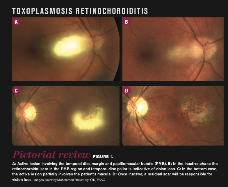 Radiation Retinopathy Ppt at Alice Abby blog