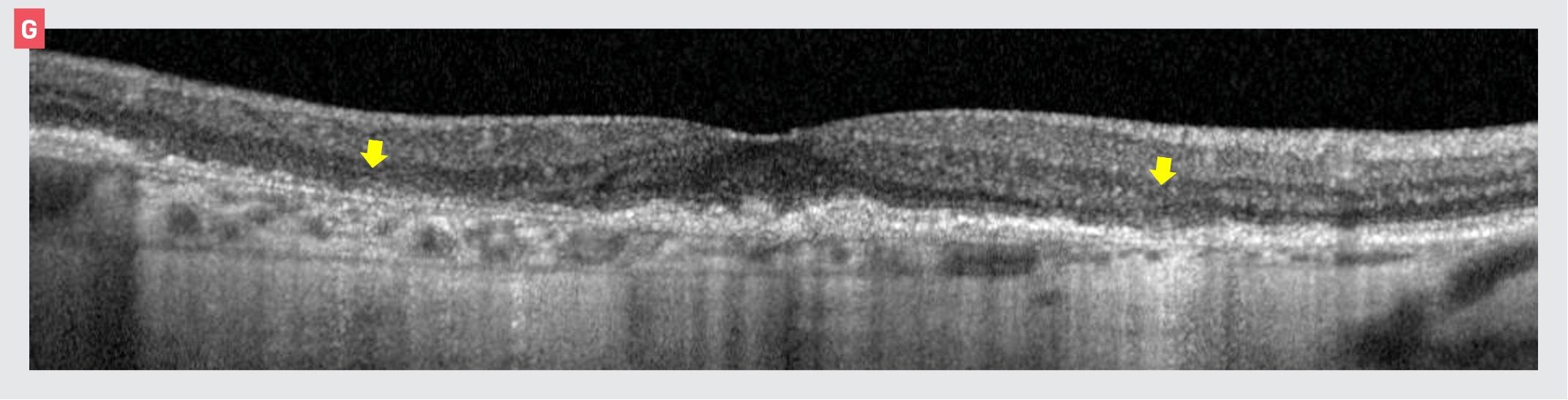 Geographic atrophy: What to know and why