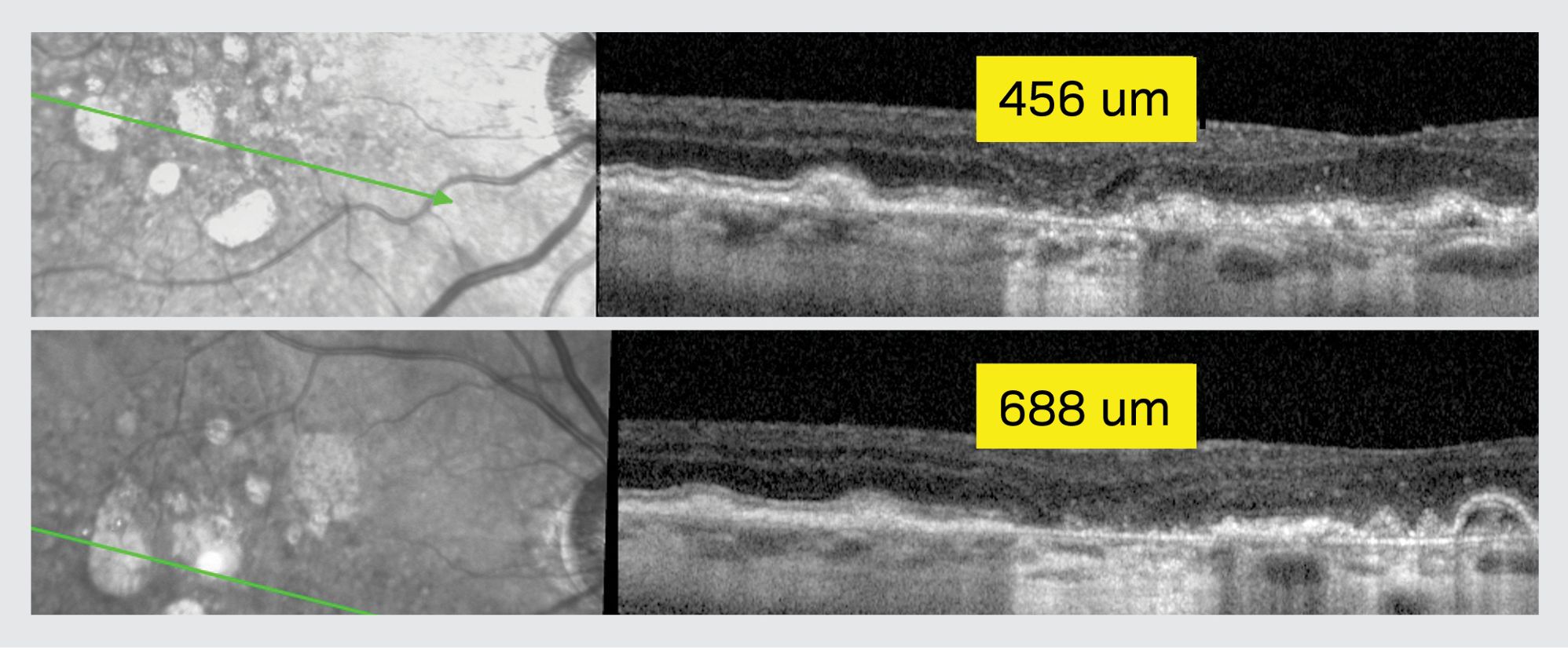 Geographic atrophy: What to know and why