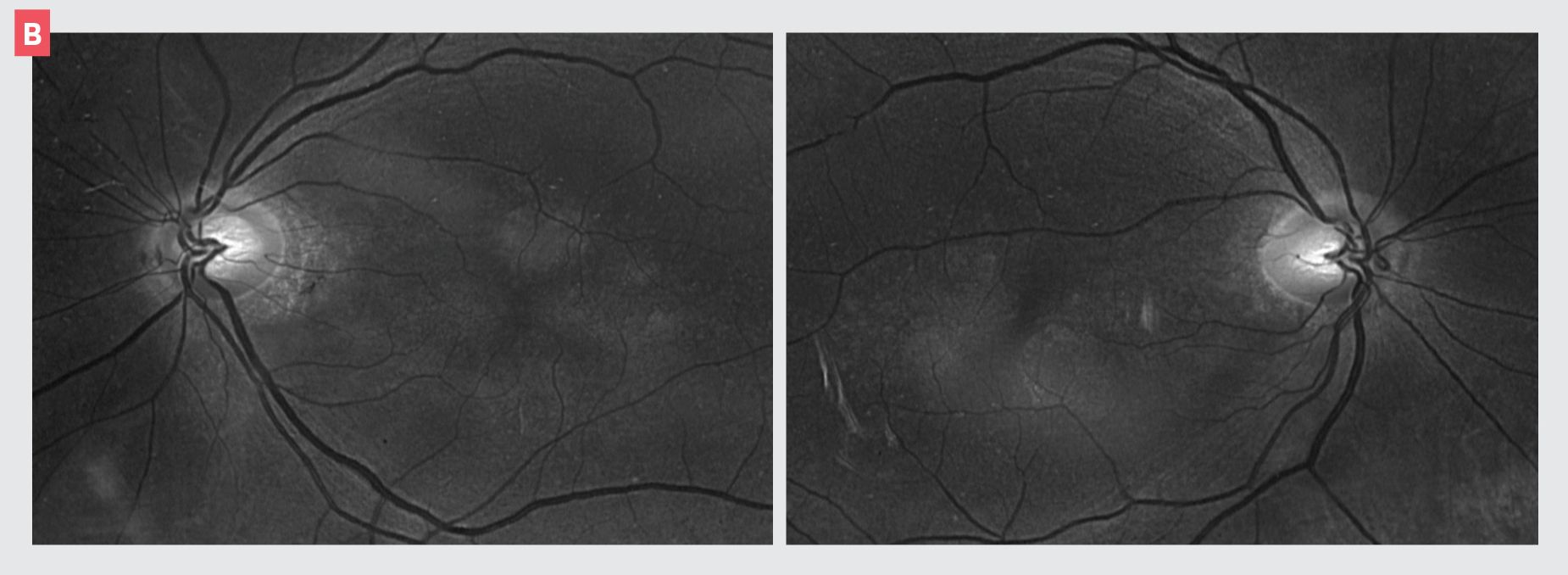 Geographic atrophy: What to know and why