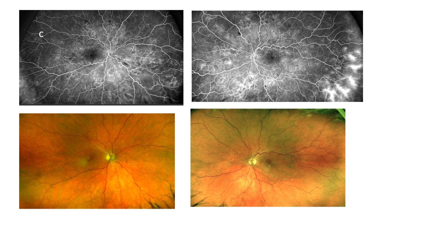 Diabetic retinopathy treatment practical review | Optometry Times