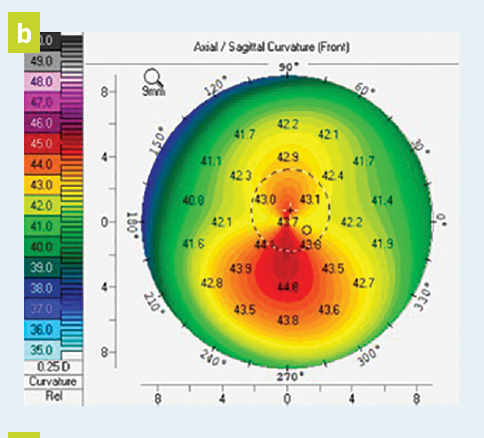 Normal Corneal Topography